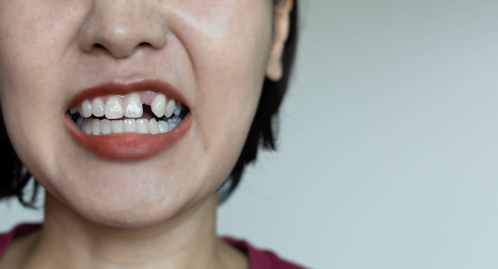 Smile Design & Dental Implants from Penticton Dentist | Enamel Dental ...