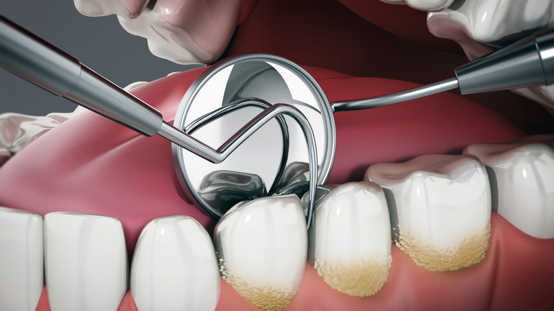 Dental Hygiene in Penticton | Enamel Dental Centre