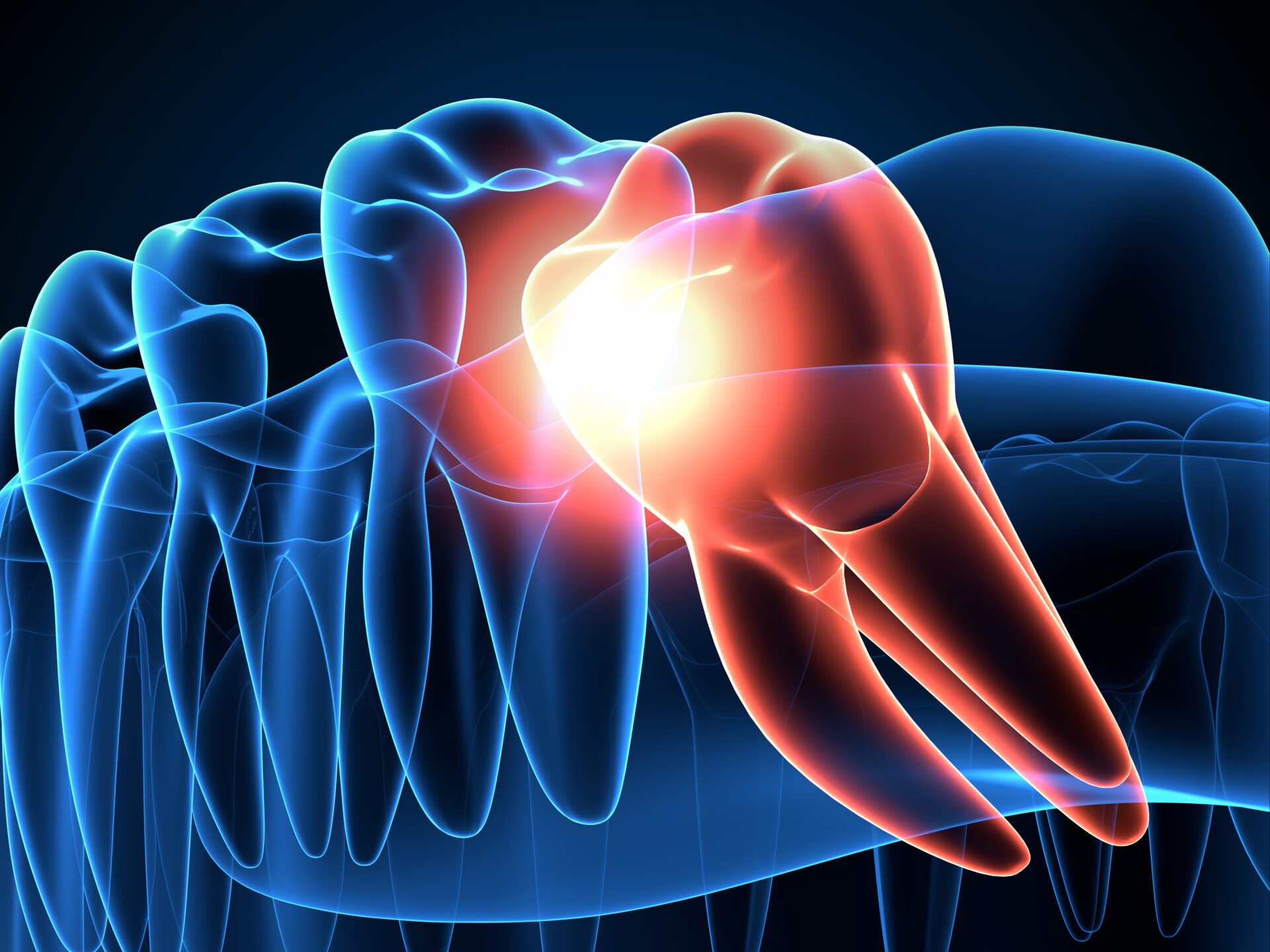 Understanding Wisdom Teeth Removal in Canada | Enamel Dental Centre
